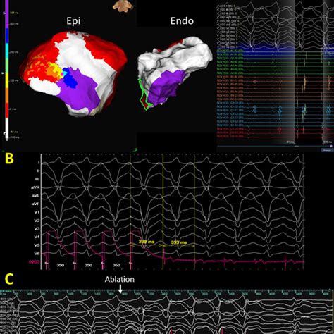 A Representative Case Of Ventricular Tachycardia Vt Isthmus Download Scientific Diagram