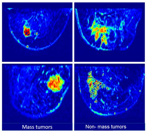 Mri Breast Tumor Segmentation Using Different Encoder And Decoder Cnn Architectures