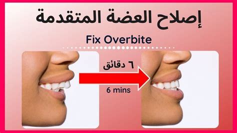 How To Naturally Fix An Overbite In 2025 Face Exercises Fix Overbite