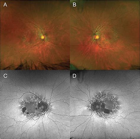 Syndromic Pattern Dystrophy Due To A Mitochondrial Dna Variant New Retinal Physician