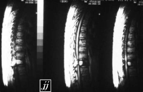 Spine Epidural Tumor Of Dorsal Spine Compression Cord Radioogle