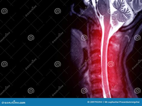 Mri Of C Spine Or Magnetic Resonance Image Of Cervical Spine Sagittal