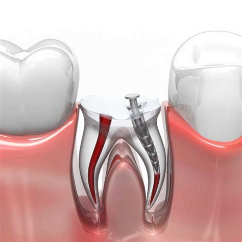 Endodontics Lotus Dental Clinic