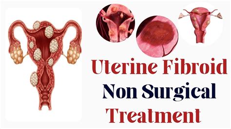 Treating Uterine Fibroid Without Surgery Embolization Uterinefibroidtreatment
