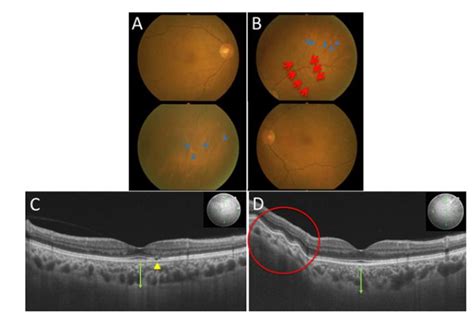 David Rp Almeida Md Mba Phd On Linkedin Nice Review And Multimodal Imaging Of Sclerochoroidal