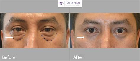 Lower Blepharoplasty Before And After Gallery Taban Md