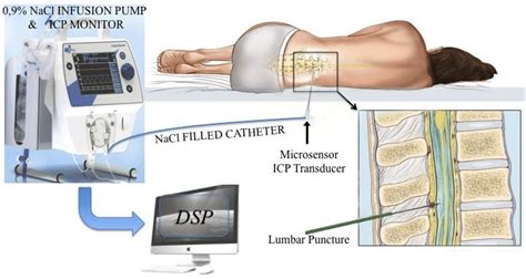 It Is Shown The Icp Monitoring Diagram Adopted To Perform The Infusion