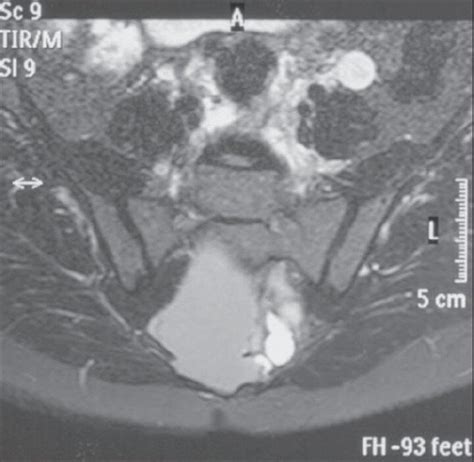 Magnetic Resonance Imaging Showing A Large Mass Lesion In Pre Sacral