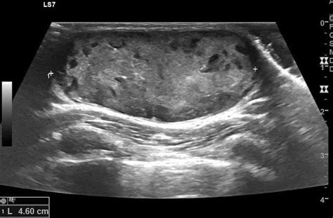 Epidermoid Cysts Chest