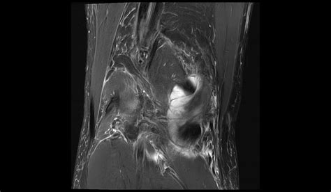 Bakers Cyst Rupture Mri Radiology Article On Baker Cyst Rupture