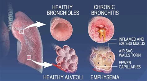Emphysema Concept Map Risk Factors Pathophysiology When The Airspaces