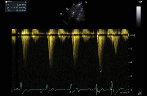 A Clinically And Echocardiographically Demonstrable Dynamic Left Ventricular Outflow Tract