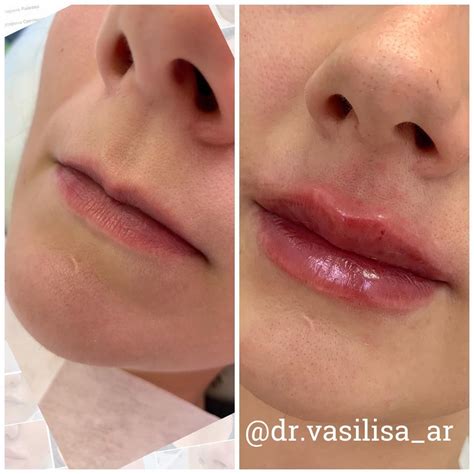 Увеличение губ до и после Губы Увеличение губ Инъекции губ