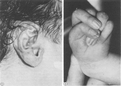 Bat Ears Ear Deformities At Liam Threlfall Blog
