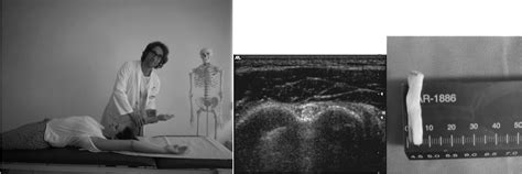 Figure 2 From Diagnostic Value Of The Hourglass Biceps Test For The