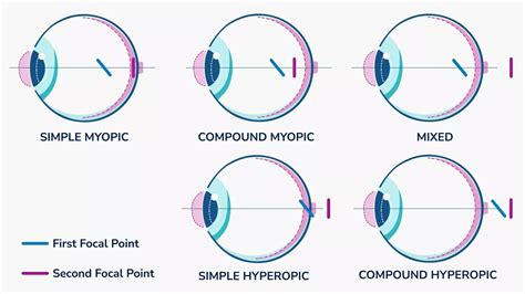 Understanding The Different Types Of Astigmatism Acuvue
