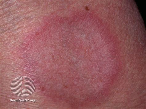 Granuloma Annulare Dermnet Nz Dermal Infiltrative Granuloma Annulare