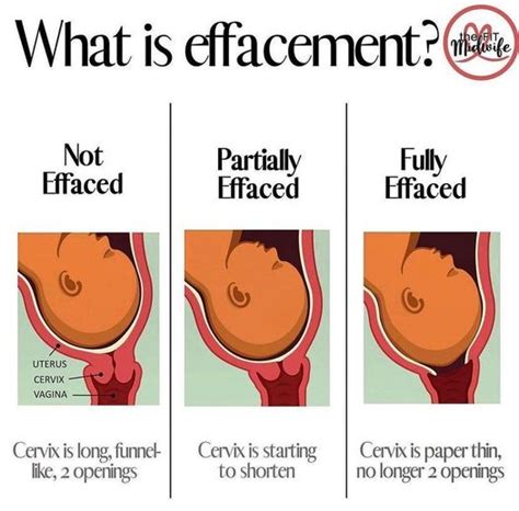 E Midwife Do You Know What Is Means When Your Cervix Is Effacing