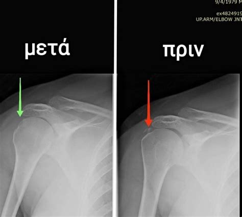 Dissolution Of Shoulder Calcification Physiotherapy Athens