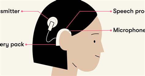 What Is A Cochlear Implant Cochlear Nerve Function And Stimulation