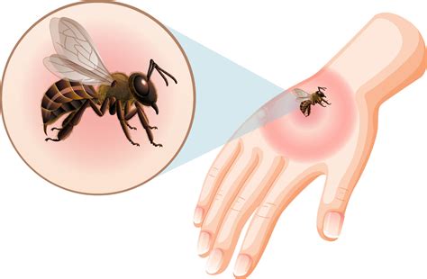 Bee Bites Sting On Skin 12668336 Vector Art At Vecteezy