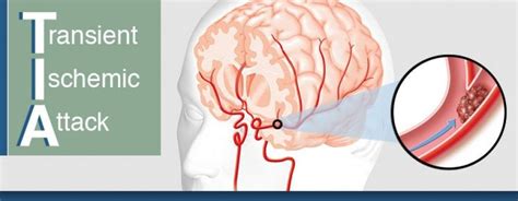 Understanding Transient Ischemic Attacks Tia Symptoms Causes And