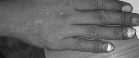 Single Well Defined Hypopigmented Slightly Atrophic Hypoaesthetic