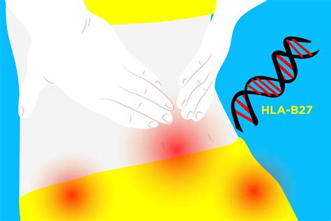 Hla B27 And Ankylosing Spondylitis What You Need To Know