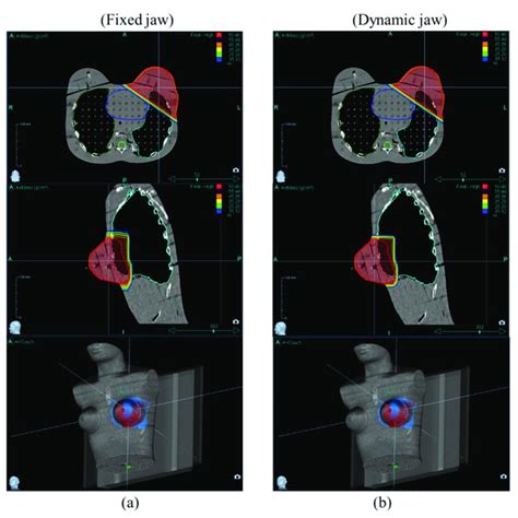 dvh comparison between fixed and dynamic modes with field width of a