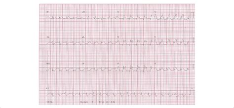 Electrocardiogram Showing St Segment Elevation In V1 To V6 And D1 And Avl Download