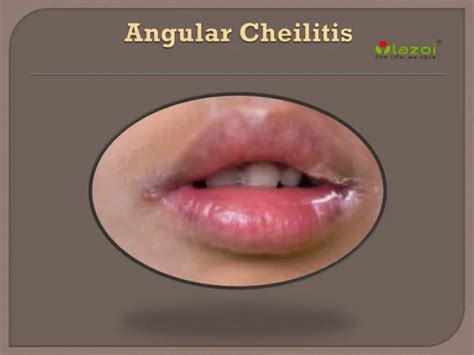 Ppt Cracked Corners Of Mouth Cheilitis Angular Cheilitis Remedy Angular Cheilitis Medicine