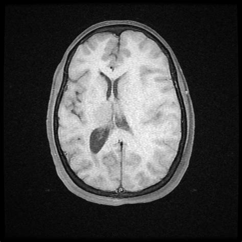 Radiopaedia Case Meningioma Left Parietal Convexity Id 61339 Study