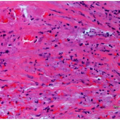 Pdf Gemcitabine Induced Skin Necrosis