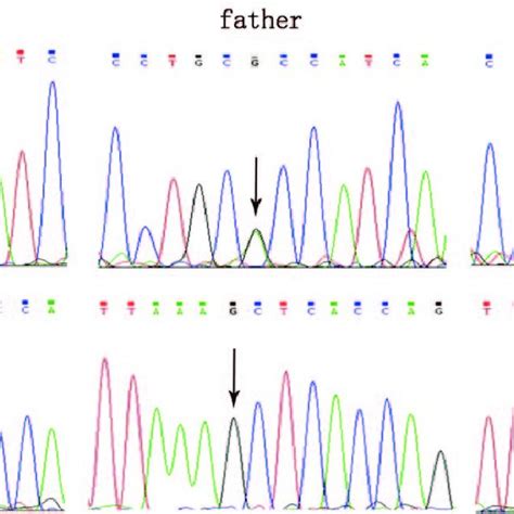 Identification Of The Compound Heterozygous Mutation Of C851gt And