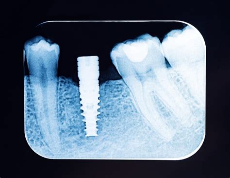 Periapical X Rays Essential Imaging For Dental Implant Planning
