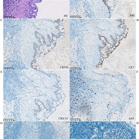 Immunohistochemical Staining Of The Tumour A The Neoplastic