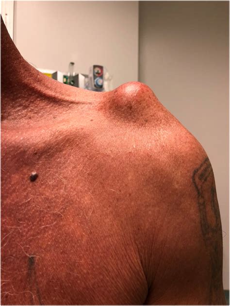 It Might Be A Tumor A Unique Presentation Of A Chronic Rotator Cuff Tear Pmc