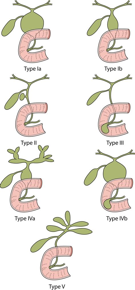 Choledochal Cyst And Gallbladder Disease Clinical Tree