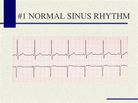 Rhythm Strip Interpretation