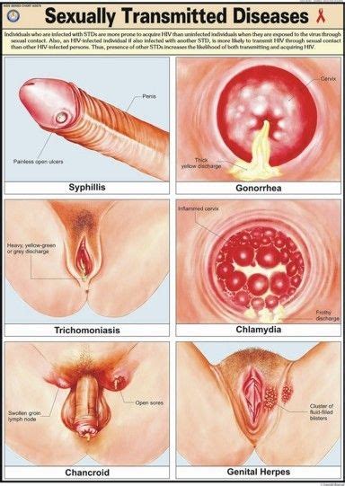 Full Color Sexually Transmitted Diseases Chart At Best Price In New Delhi N C Kansil Sons