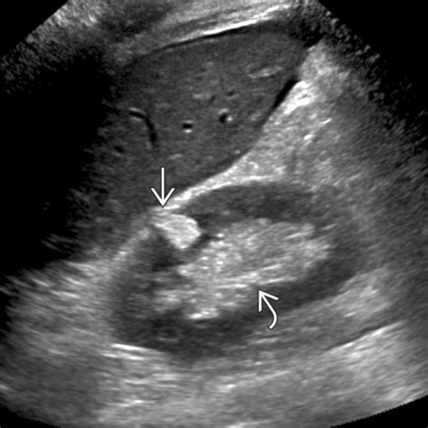 Renal Angiomyolipoma Radiology Key