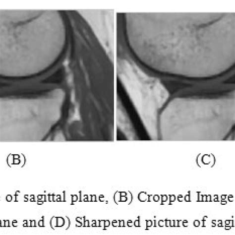 Watershed Algorithm And Adaptive Threshold Canny Edge Detection Based