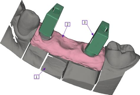 Custom Abutment Design Exocad