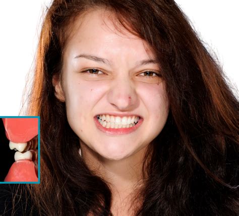 Teeth Grinding Bruxism Your Local Beecroft Dentists At Beecroft Smiles