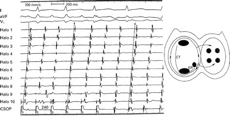 Electrophysiological Determinant For Induction Of Isthmus Dependent