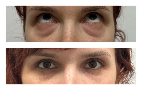 Как убрать мешки и темные круги под глазами Евгений Лешунов Пластический хирург Дзен