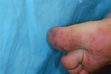 Osler Nodes Endocarditis