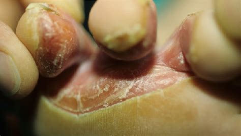 Figure 1 From Gram Negative Bacterial Toe Web Intertrigo Semantic Scholar