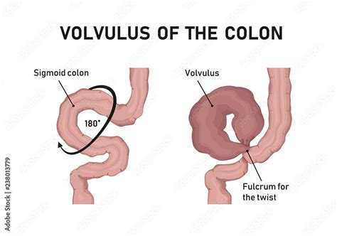 Volvulus
