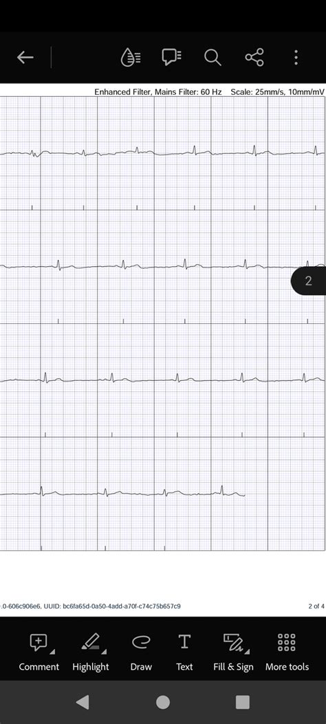 Qt Interval Long Rekg